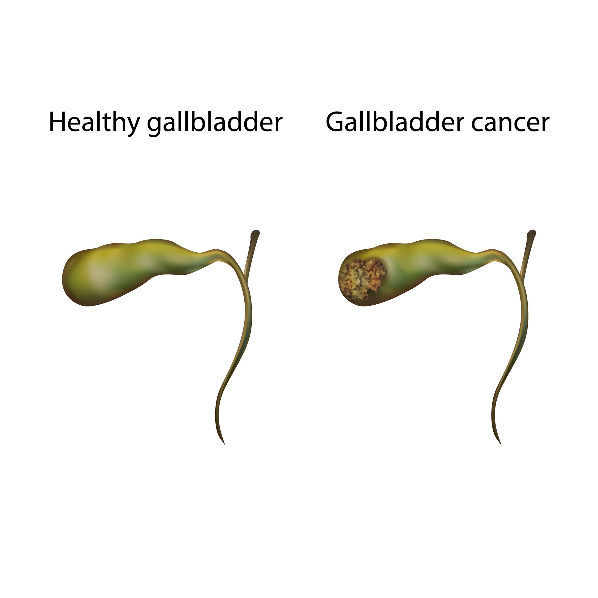 Gallbladder Cancer | Gallbladder carcinoma