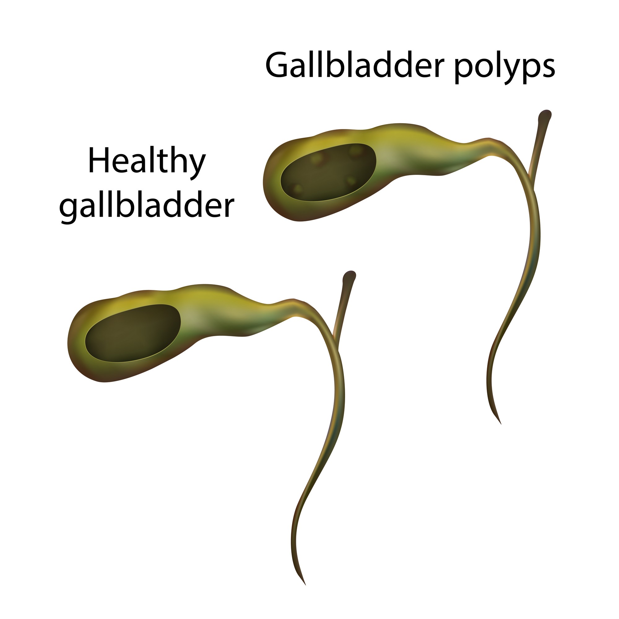 Gallbladder Polyps