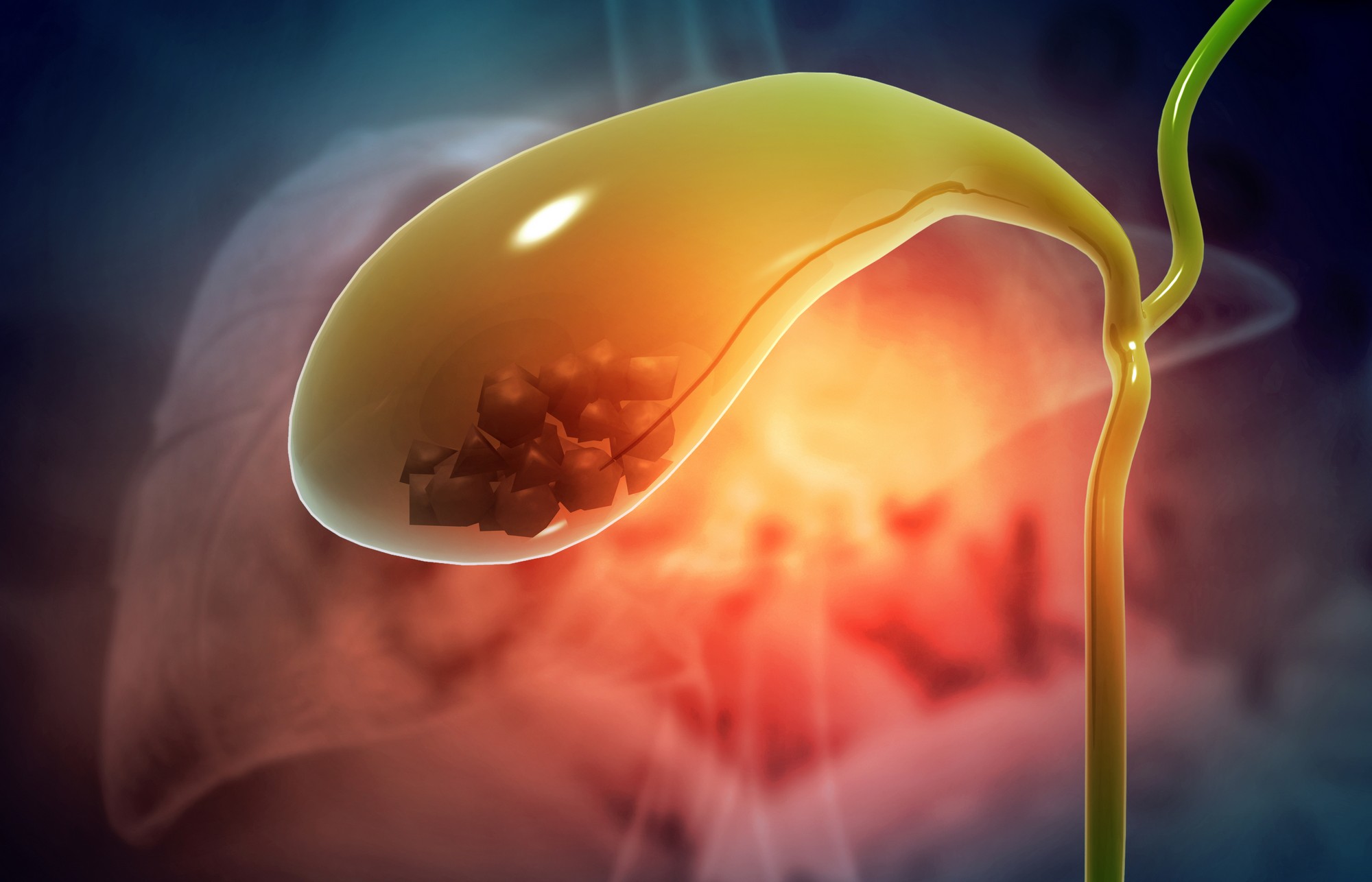Gallstones – Robotic Surgery NZ