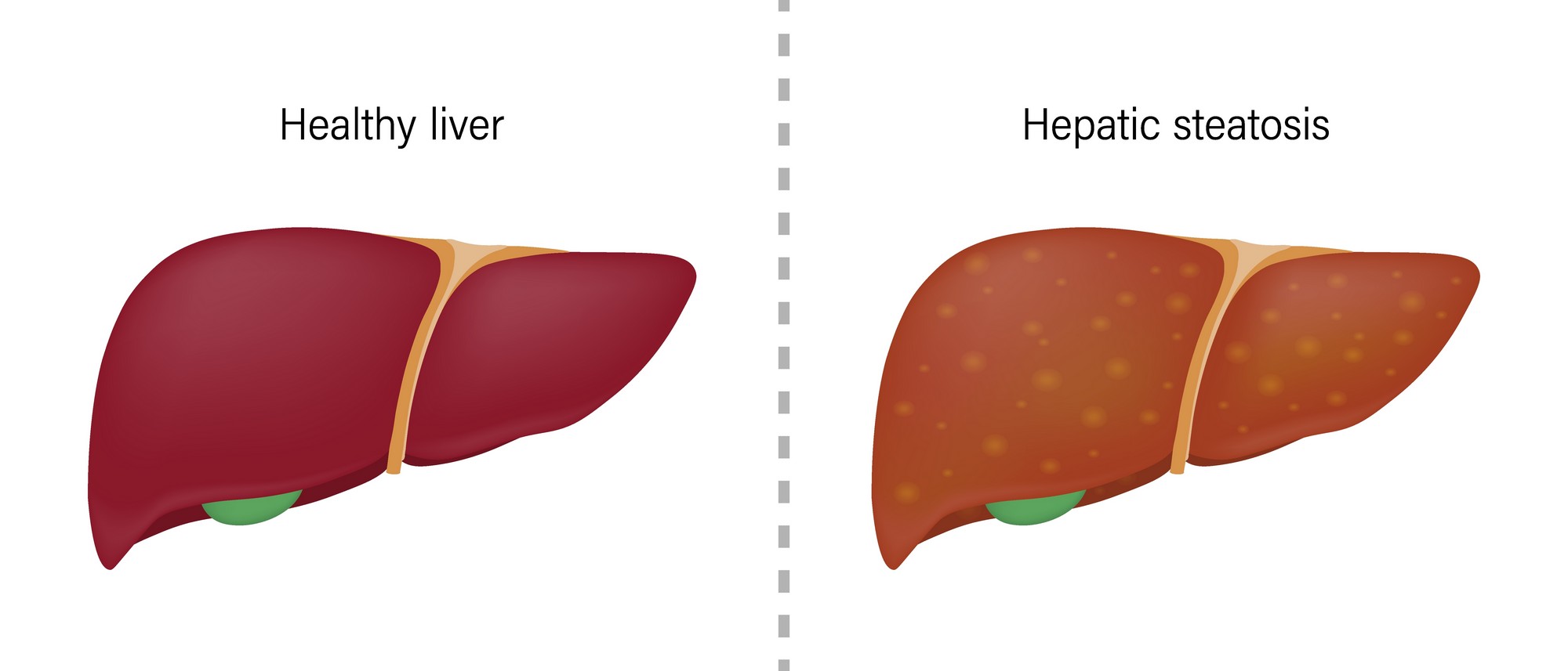 Hepatic steatosis – Robotic Surgery NZ