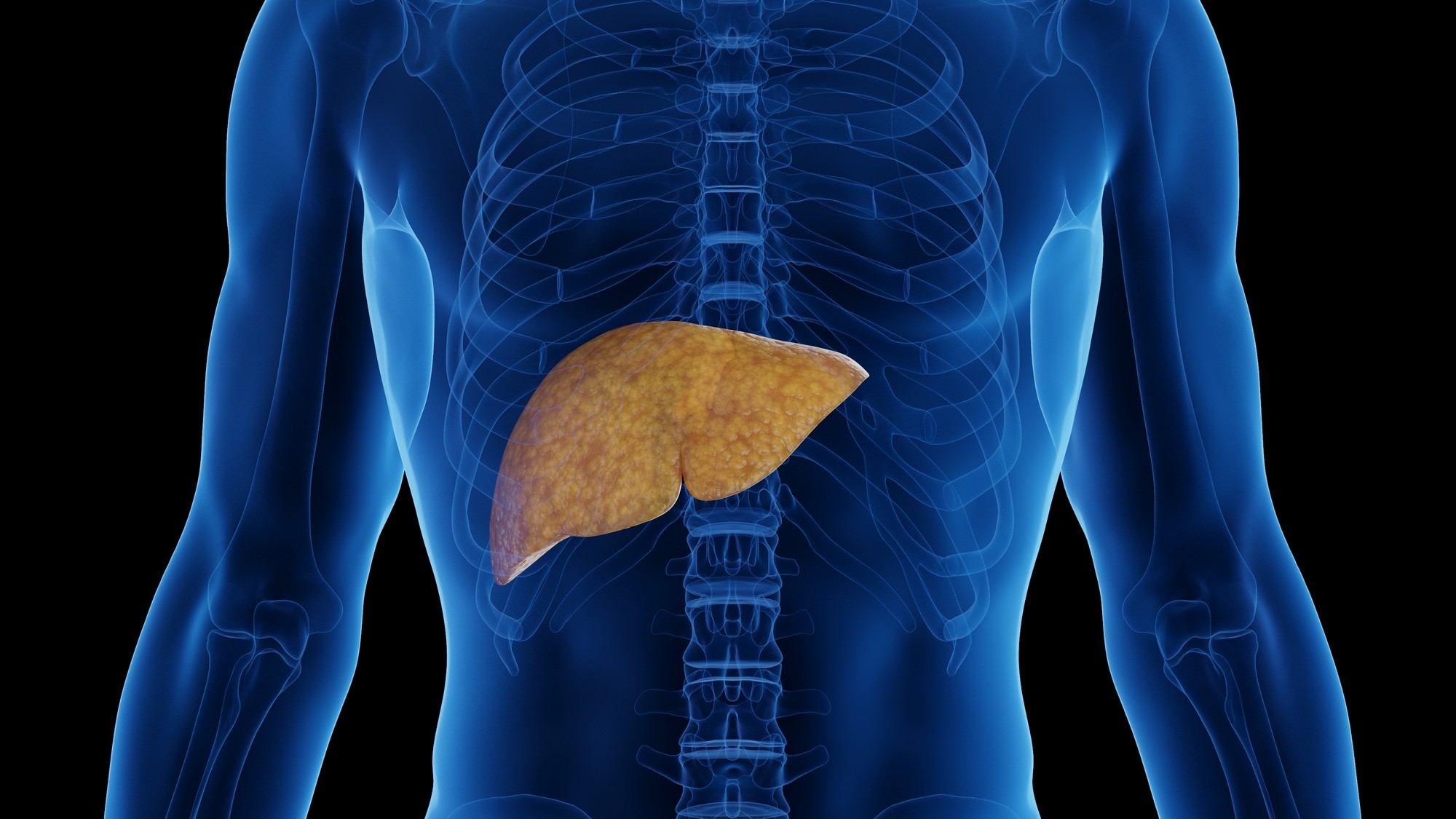 Hepatic Steatosis - Fatty Liver Disease - Non-alcoholic fatty liver disease