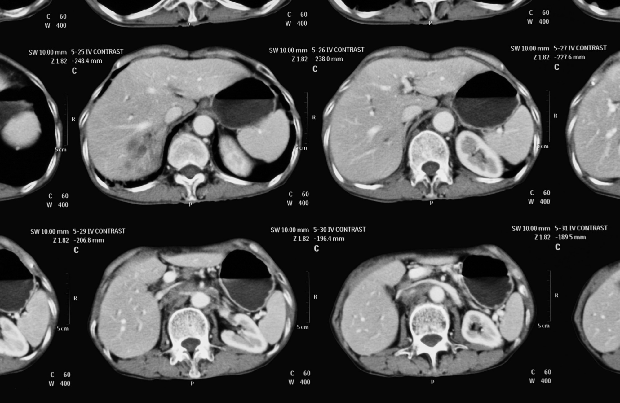 Cholangiocarcinoma - Bile Duct Cancer