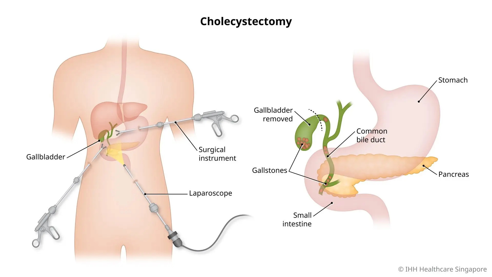 Gallbladder Archives Surgery NZ Gallbladder Archives Surgery NZ